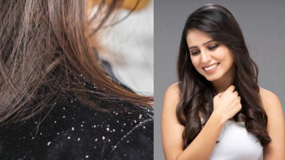 If you are troubled by dandruff hair, follow these home remedies ...
