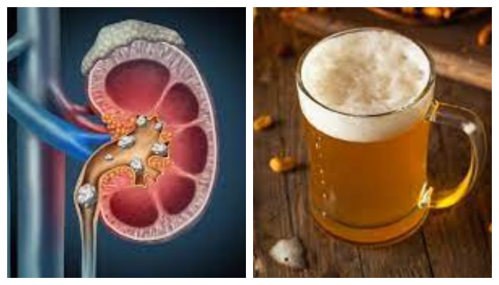does beer helps to remove kidney stone here is complete information ...