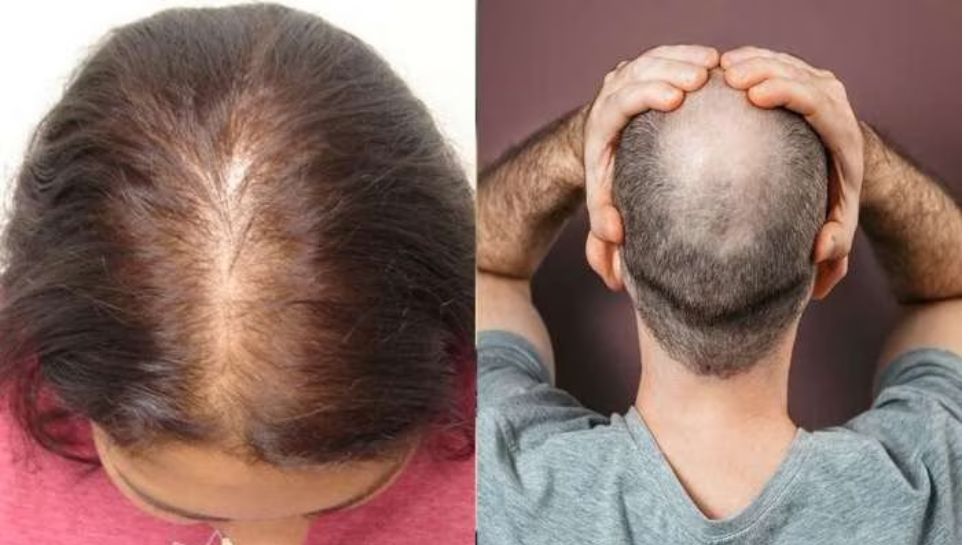 Say goodbye to baldness with these easily available home remedies ...