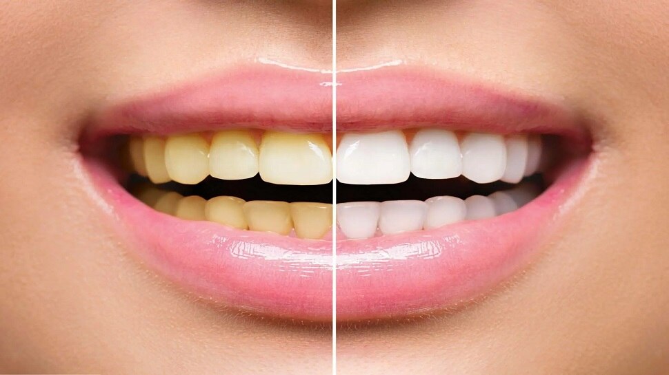 Follow these simple tips to get pearly white teeth | Home Remedies ...