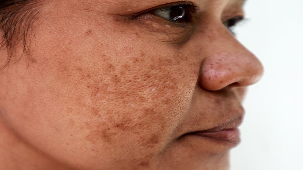 Do this to get rid of blemishes on face..your face will be radiant ...