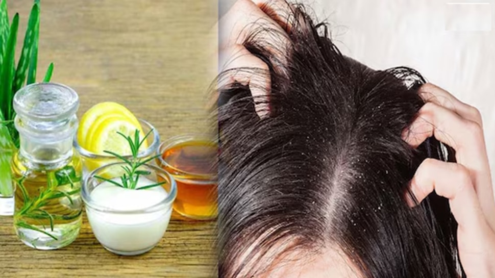 dandruf home remedy try these home remedies for dandruff and itchy ...