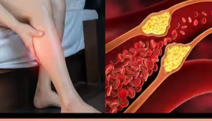 high cholesterol symptoms in leg| ಕಾಲಿನಲ್ಲಿ ಕಂಡು ಬರುವ ಈ ನಾಲ್ಕು ಲಕ್ಷಣ ...