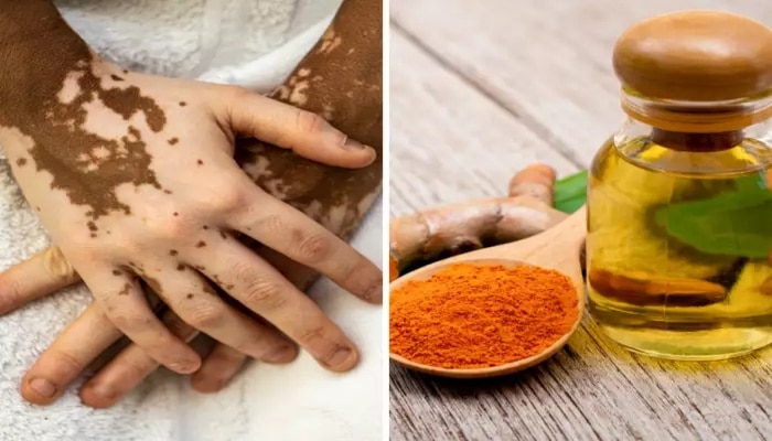turmeric to get rid of white patch on skin |ಚರ್ಮದಲ್ಲಿ ಬಿಳಿ ಕಲೆಗಳು ...