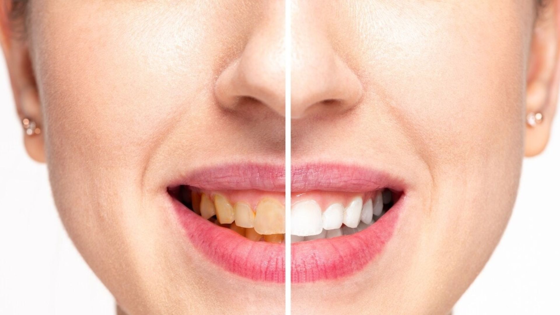 Curd and ashwagandha Mixture Turn Yellow Teeth into Whiten | Yellow ...