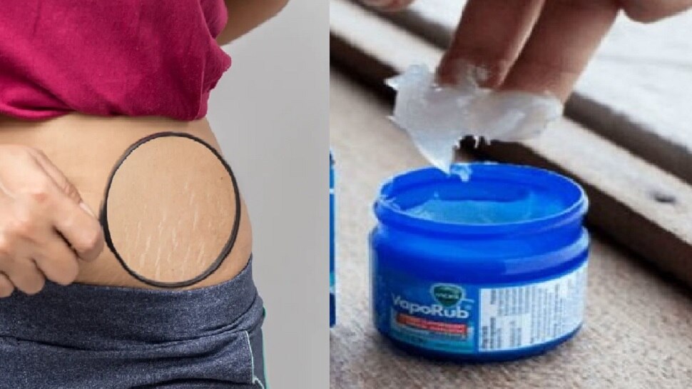 Vicks is not only used to treat colds and coughs stretch marks can also ...