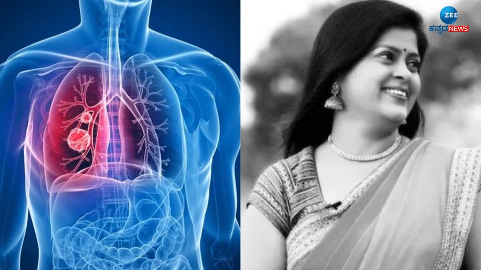 Aparna Vastarey dies: Know what causes of lung cancer even in non ...