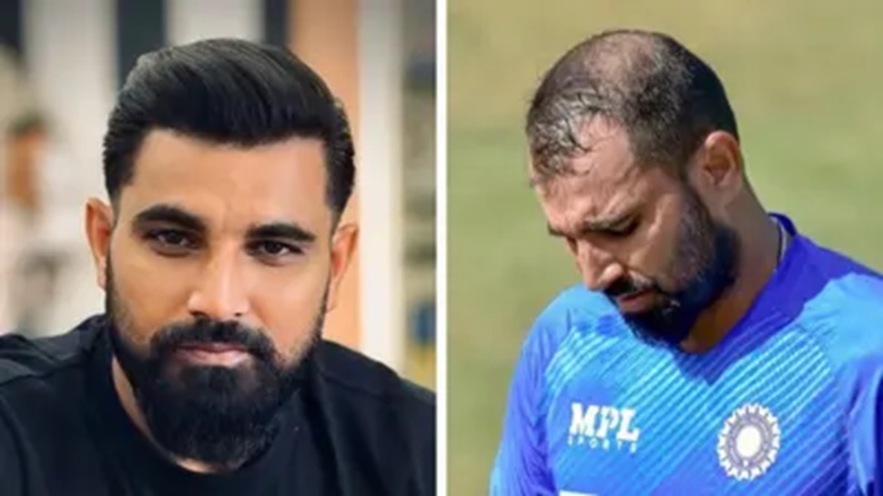 Cricketer Mohammed Shami look and Hair Transplant gets by celebrity ...