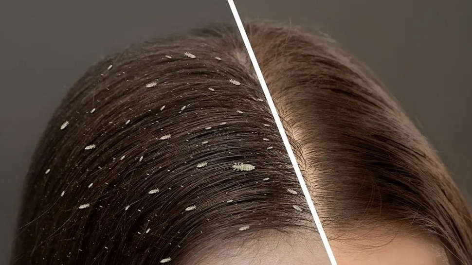 How to remove lice from hair permanently| ತಲೆ ತುಂಬಾ ಹೇನು ಇದ್ದು ತುರಿಸ್ತಾ ...