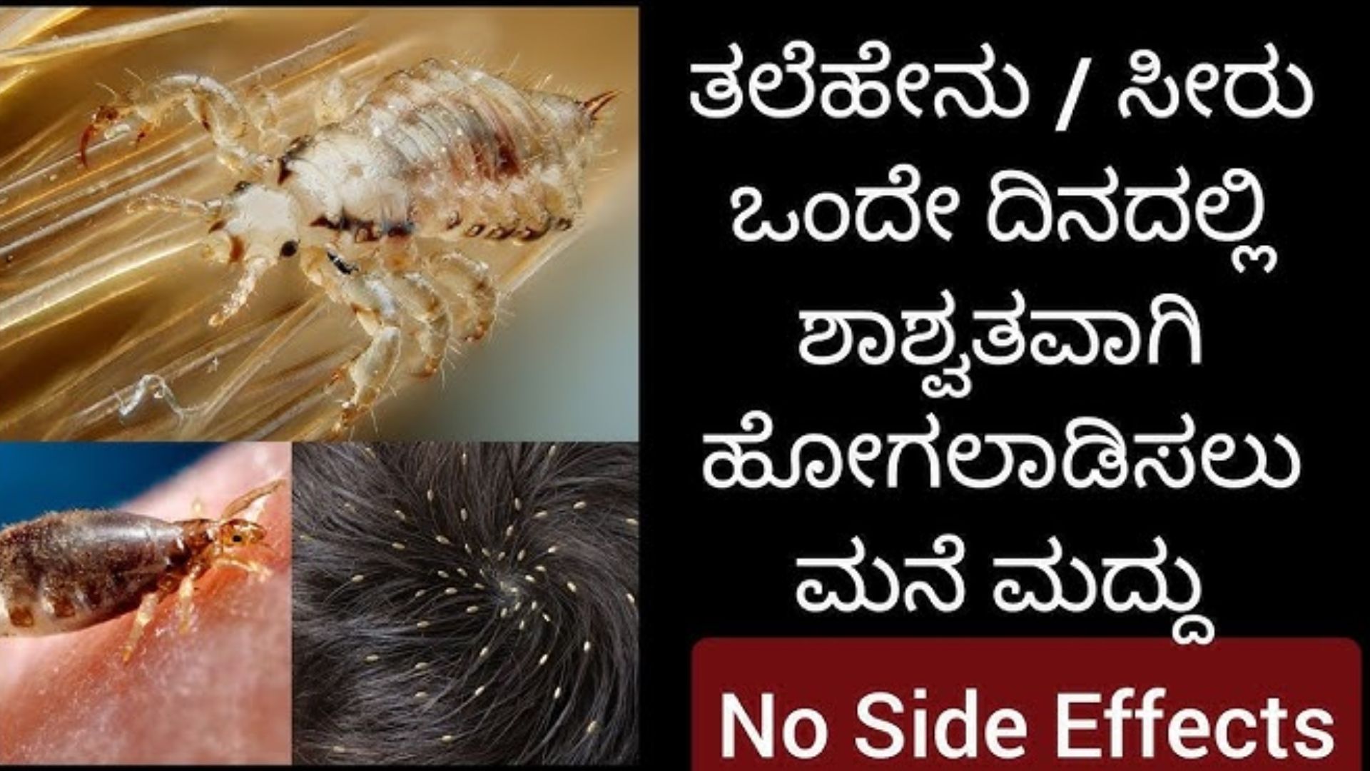 Here is the solution to head lice problem | ತೆಂಗಿನ ಎಣ್ಣೆಯಲ್ಲಿ ಈ ಪುಡಿ ...