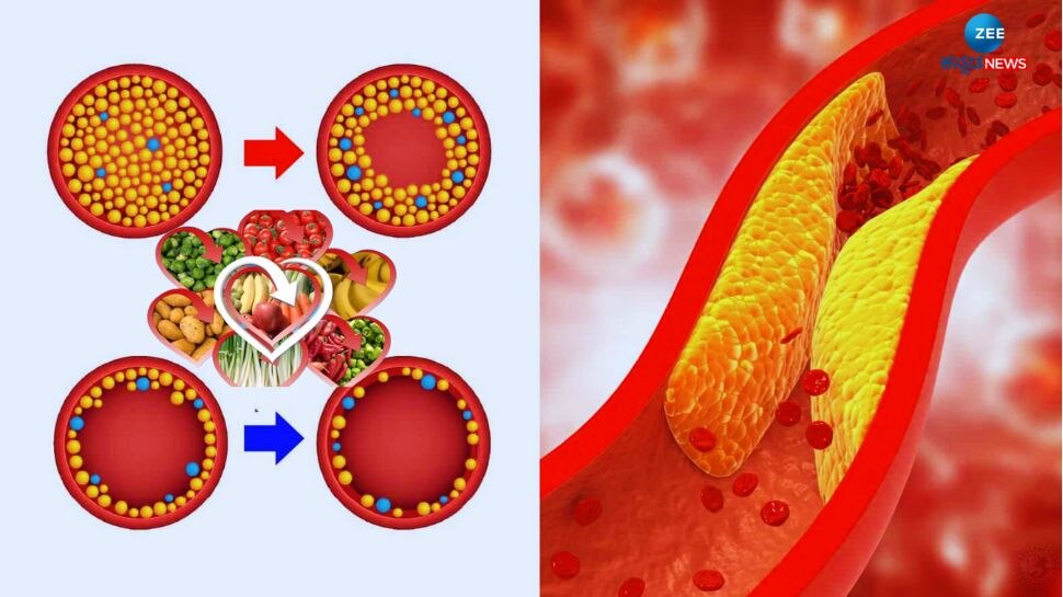 Health Tips: Know High Cholesterol Symptoms and Causes |ಯಾವುದೇ ಟೆಸ್ಟ್ ...