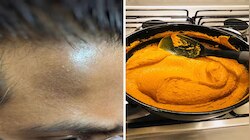 Latest Kannada News how to get rid of forehead darkness, how to get rid ...