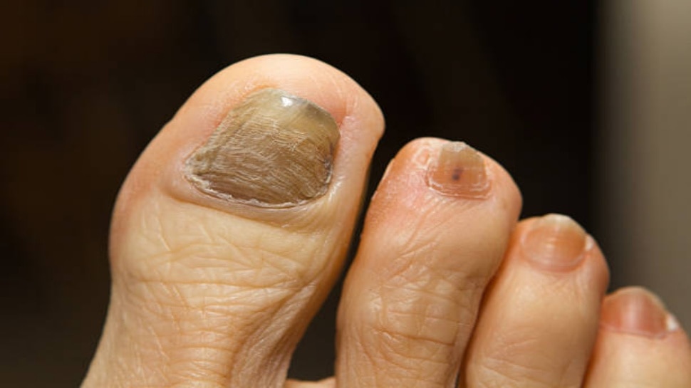 Early stage diabetes blisters on feet: Donot neglect a nail fungus it ...