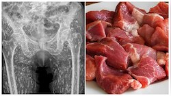 Latest Kannada News Infested X Ray, Infested X Ray News in Kannada ...