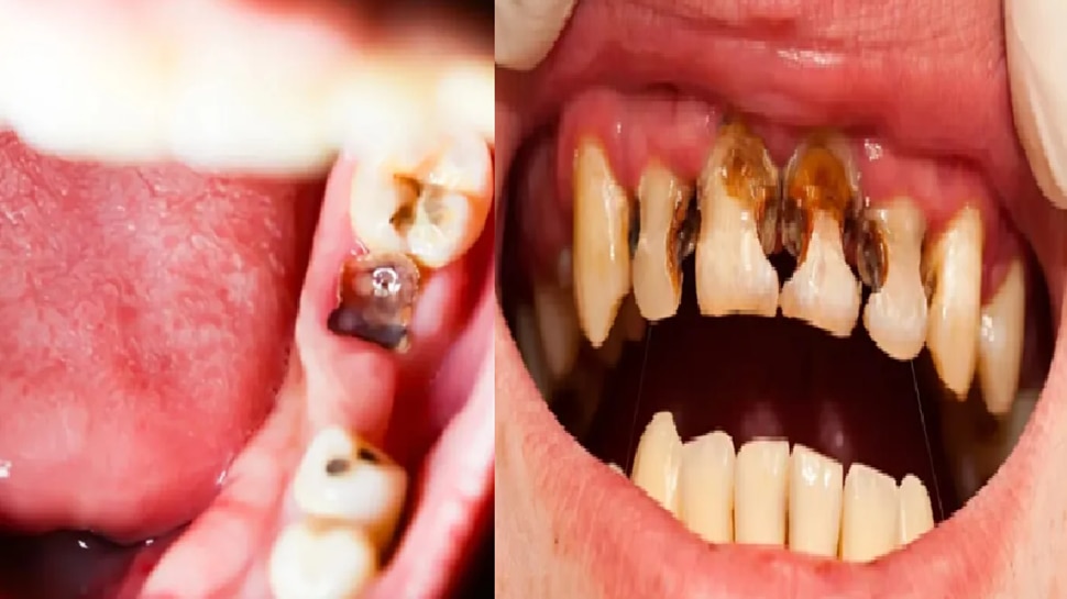 Due to this teeth start rotting and a terrible smell starts coming from ...