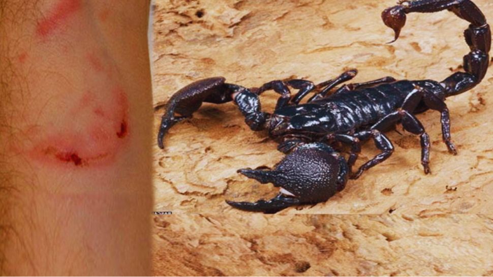 Scorpion Bite treatment at home | ಚೇಳು ಕಚ್ಚಿದ ಕೂಡಲೇ ಹೀಗೆ ಮಾಡಿದ್ರೆ 'ವಿಷ ...