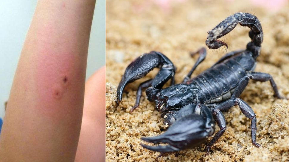 Scorpion Bite treatment at home | ಚೇಳು ಕಚ್ಚಿದ ಕೂಡಲೇ ಹೀಗೆ ಮಾಡಿದ್ರೆ 'ವಿಷ' ಮೈಗೇರಲ್ಲ...! News in Kannada