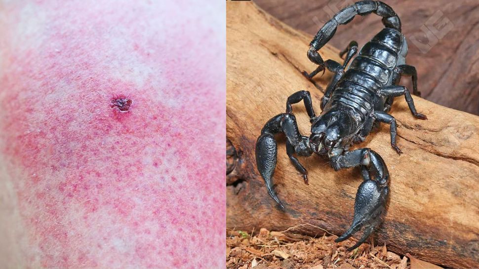 Poisonous scorpion sting first aid treatment that helps remove venom ...