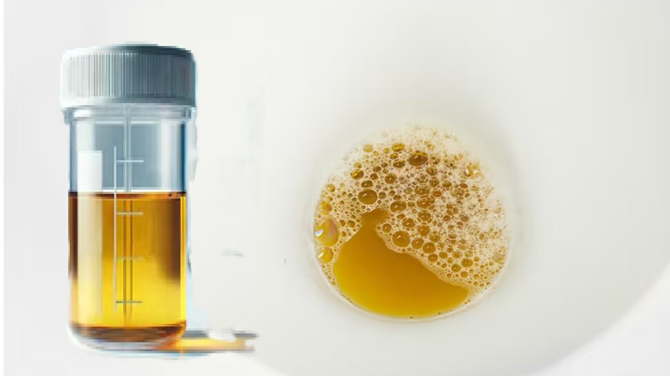 It is not normal to have dark yellow urine in the morning: know what ...