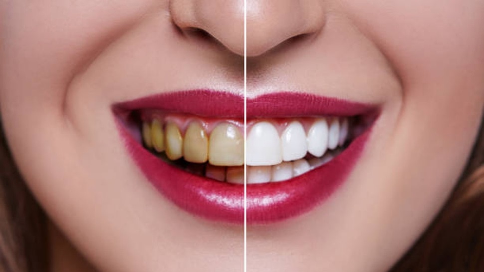 Yellow Teeth Home Remedy: How To get rid of teeth stains with orange ...