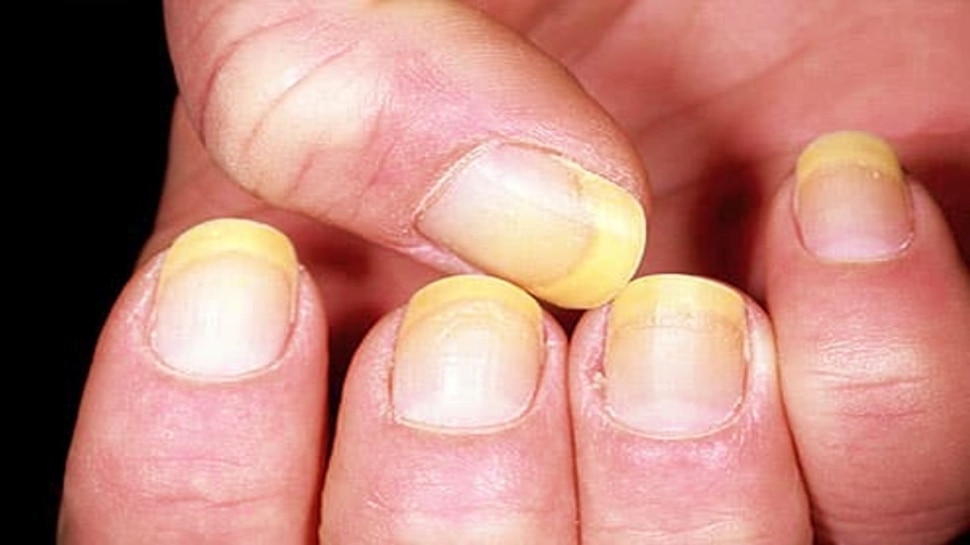 fungal nail infection in diabetes and yellow nails in sugar patient ...
