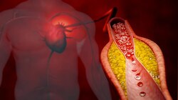 Latest Kannada News Chest pain blocked artery, Chest pain blocked ...