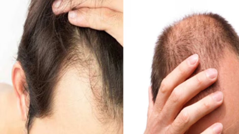 Why is hair falling out in men? Here are the main reasons | ಪುರುಷರಲ್ಲಿ ...