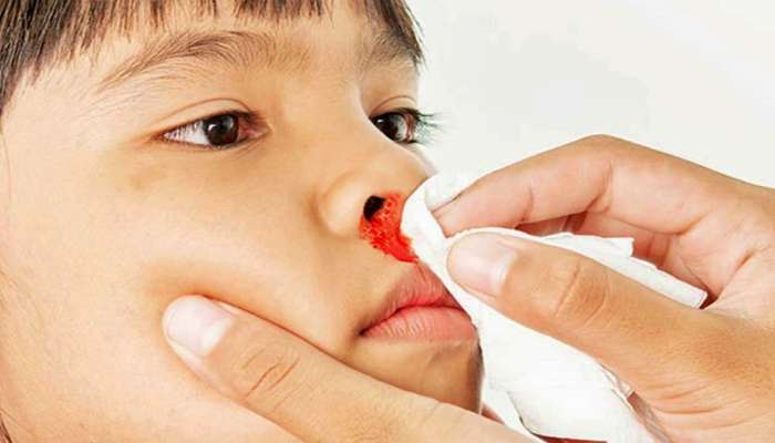 what causes nosebleeds in children | ಪೋಷಕರೇ..! ಮಕ್ಕಳ ಮೂಗಿನಲ್ಲಿ ...